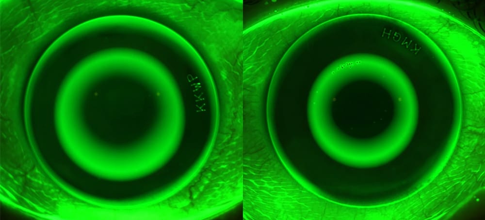 Managing Adults with Myopia - mivision