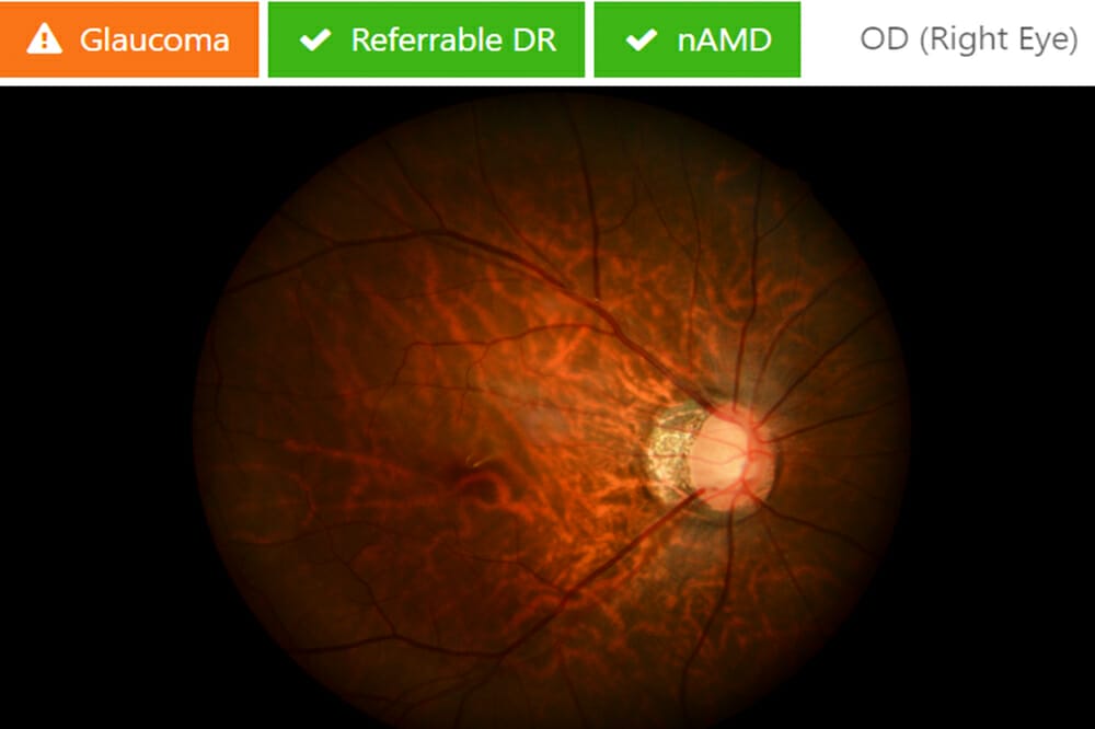 Artificial Intelligence in Eye Care: The Future is Now - mivision