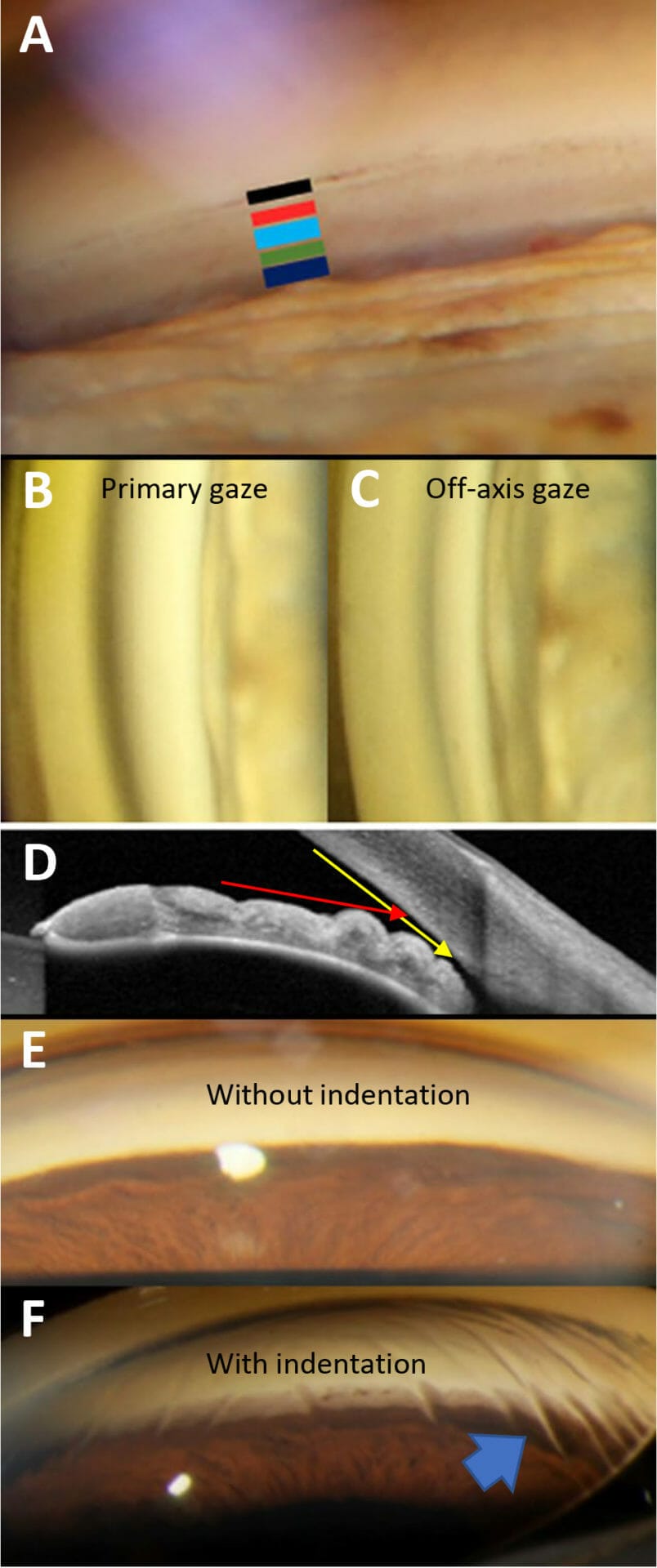 Angle Closure: Narrowing Your Diagnosis - mivision