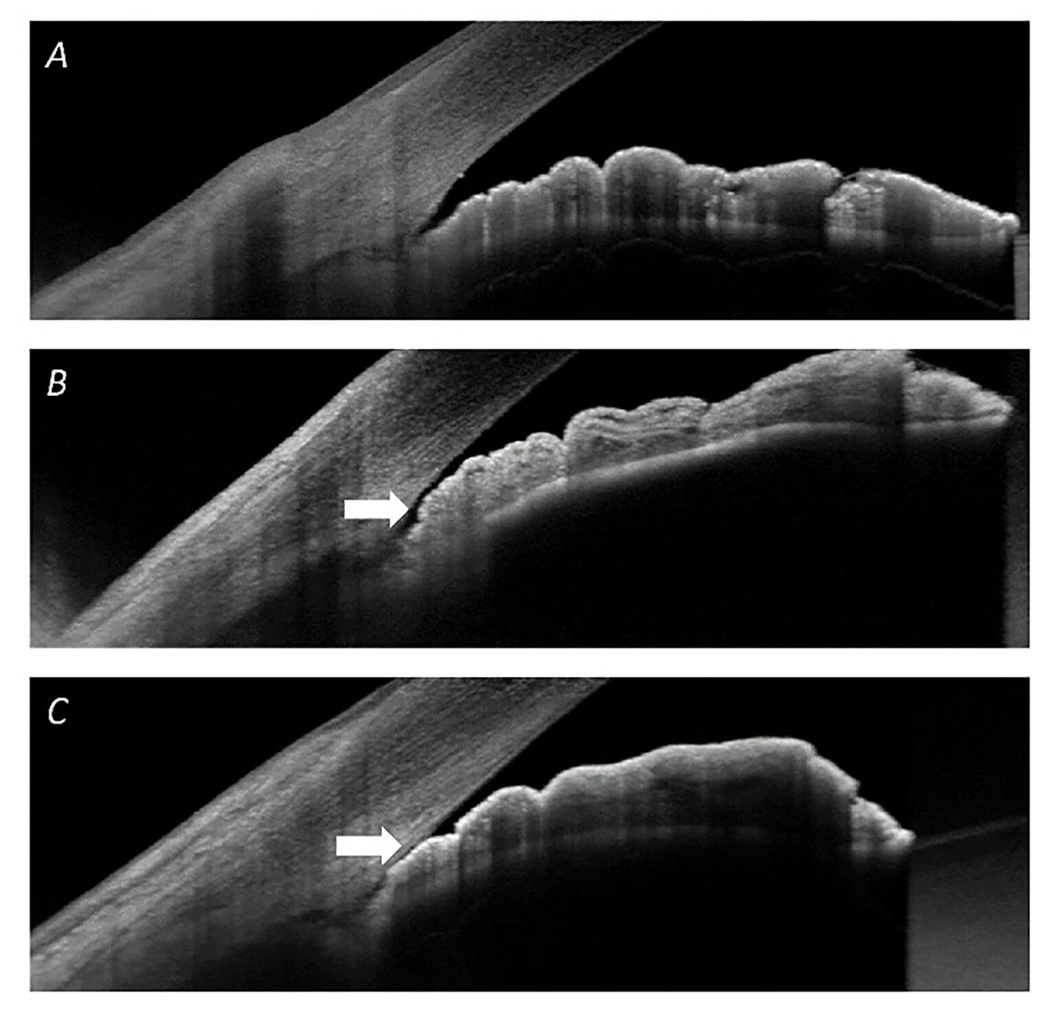 Angle Closure: Narrowing Your Diagnosis - mivision