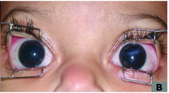 Congenital Glaucoma: What Optometrists Need to Know - mivision