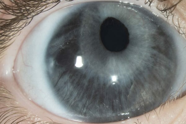 Childhood Glaucoma Keys to Management - mivision