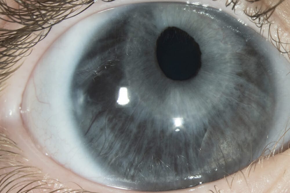 Childhood Glaucoma Keys to Management - mivision