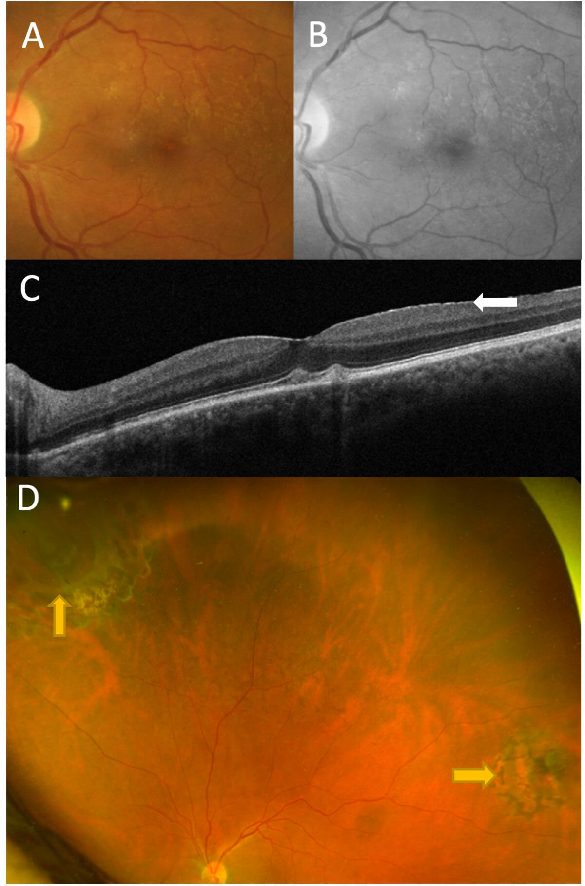 Epiretinal Membranes A Clinical Approach for Optometrists - mivision