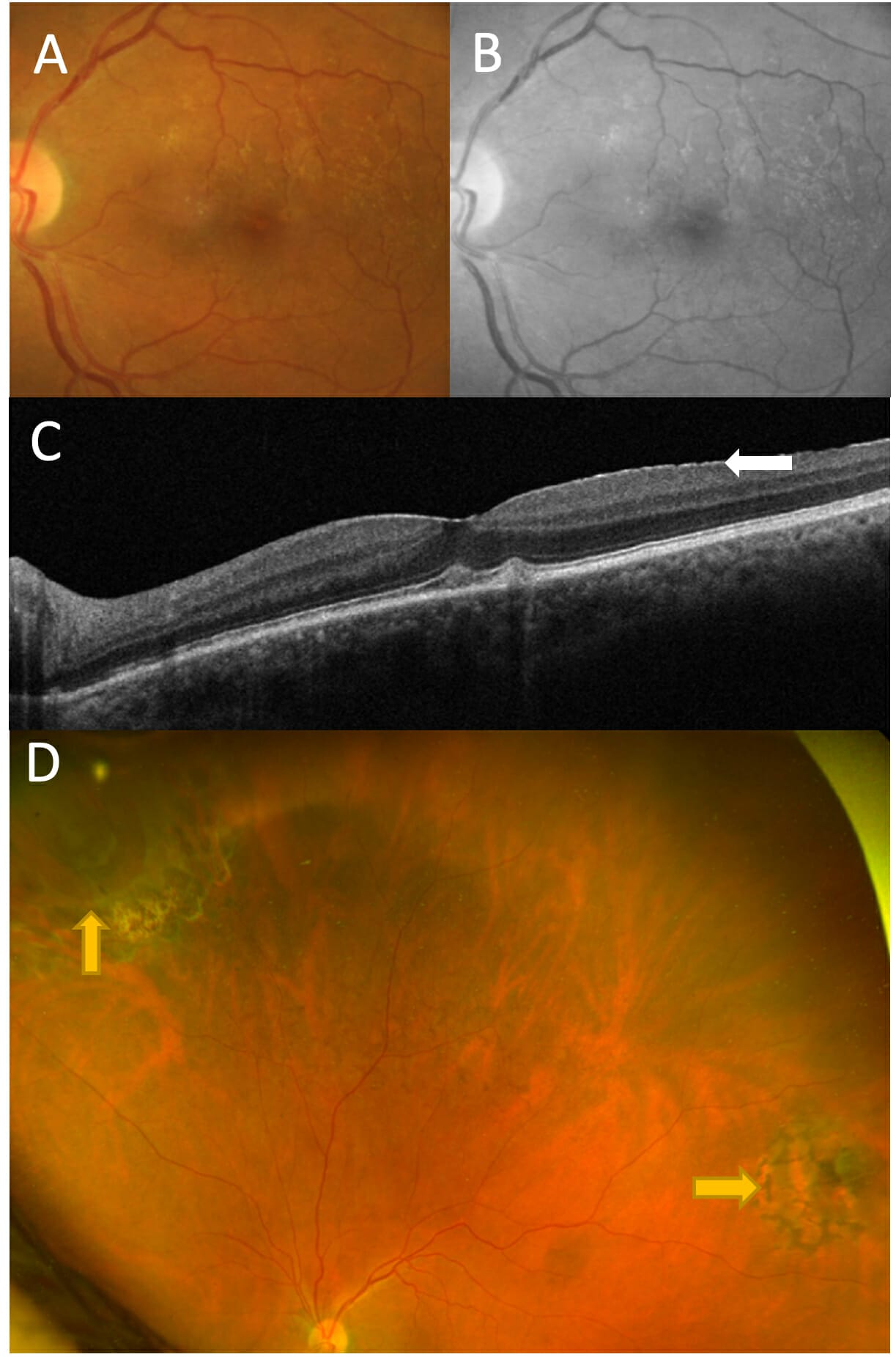 Epiretinal Membranes A Clinical Approach for Optometrists - mivision