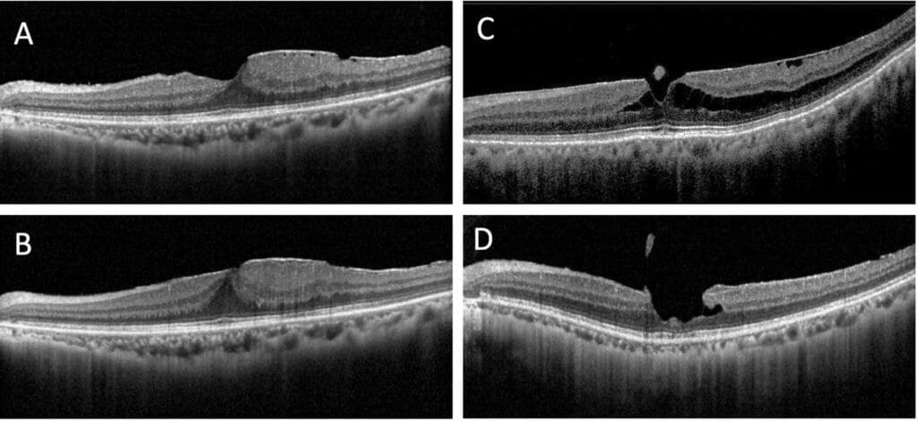 Epiretinal Membranes A Clinical Approach for Optometrists - mivision