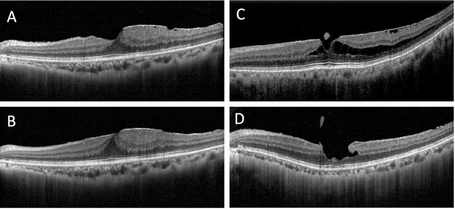 Epiretinal Membranes A Clinical Approach for Optometrists - mivision