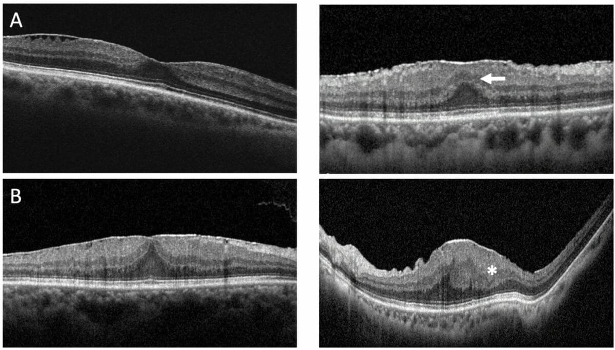 Epiretinal Membranes A Clinical Approach for Optometrists - mivision