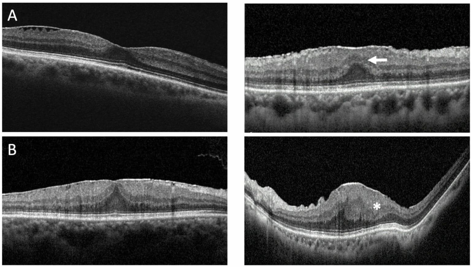 Epiretinal Membranes A Clinical Approach for Optometrists - mivision