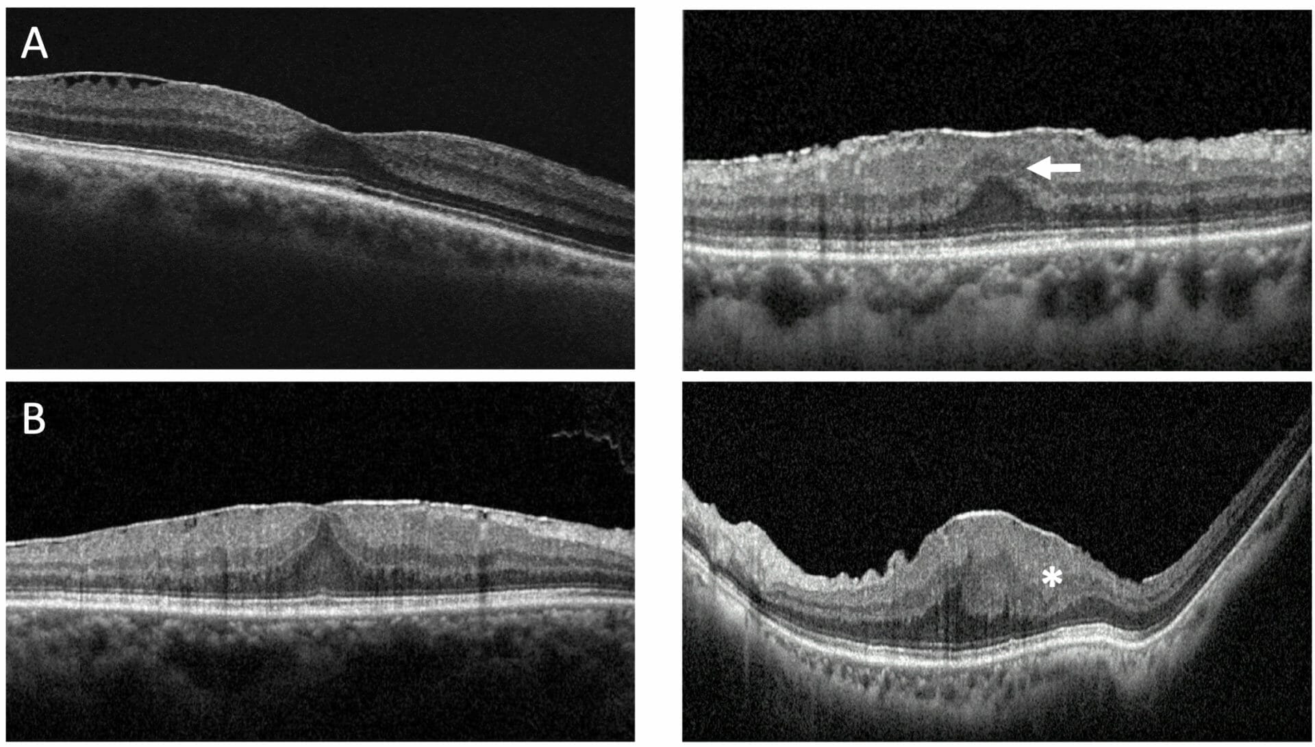 Epiretinal Membranes A Clinical Approach for Optometrists - mivision
