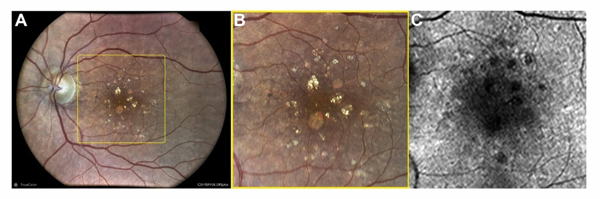 Geographic Atrophy Three Tell-Tale Signs - mivision