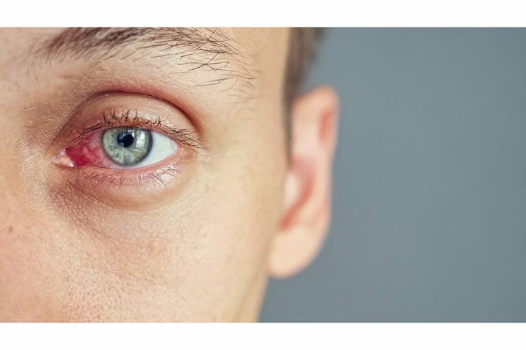 Cequa Now Reimbursed for Chronic Severe DED - mivision