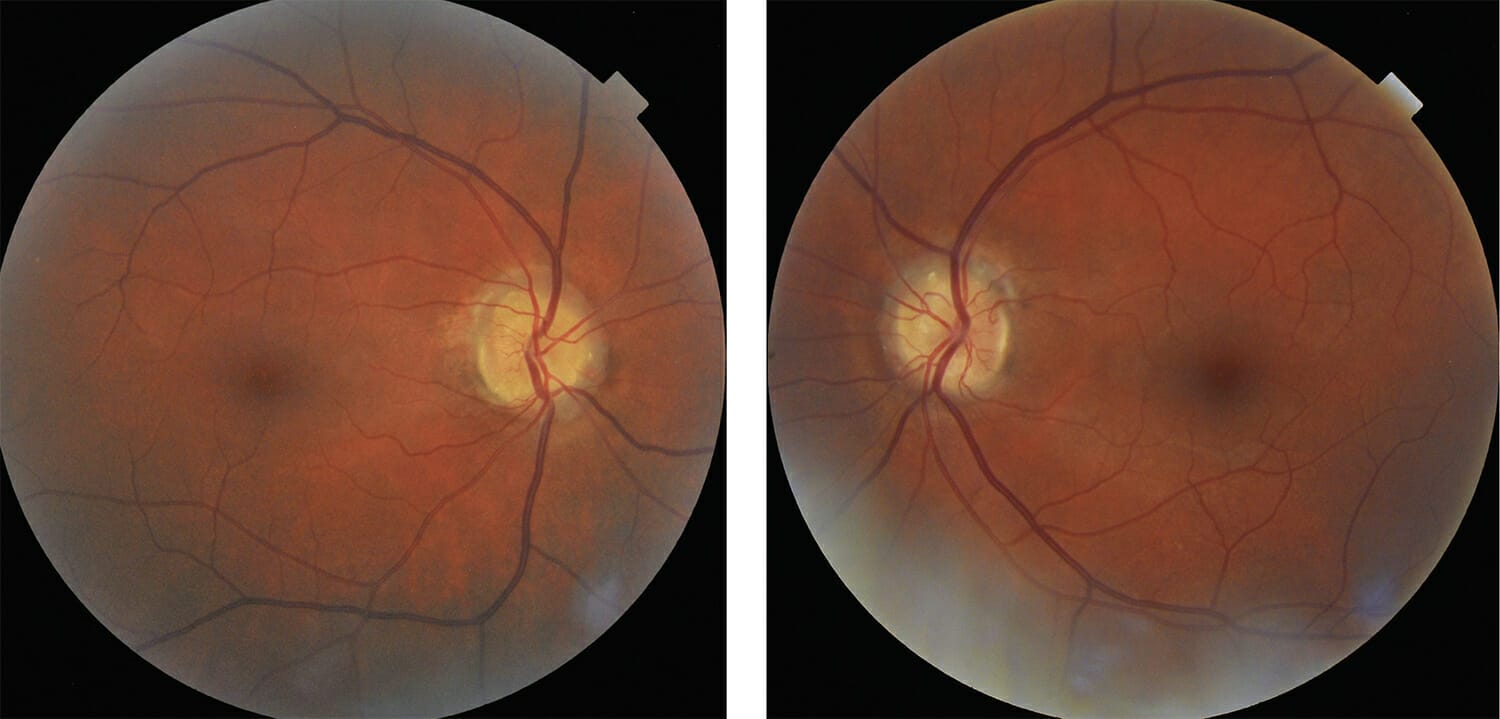 Navigating Visual Fields in Optic Nerve Head Drusen - mivision