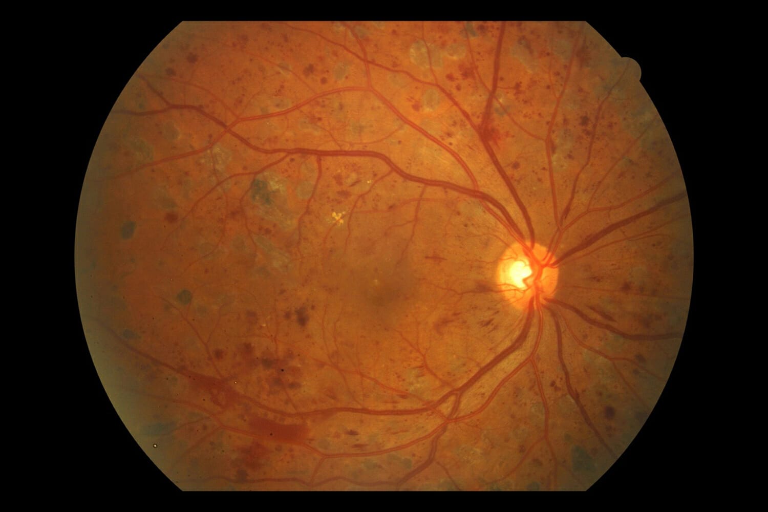 Severe Diabetic Retinopathy Management Update - mivision