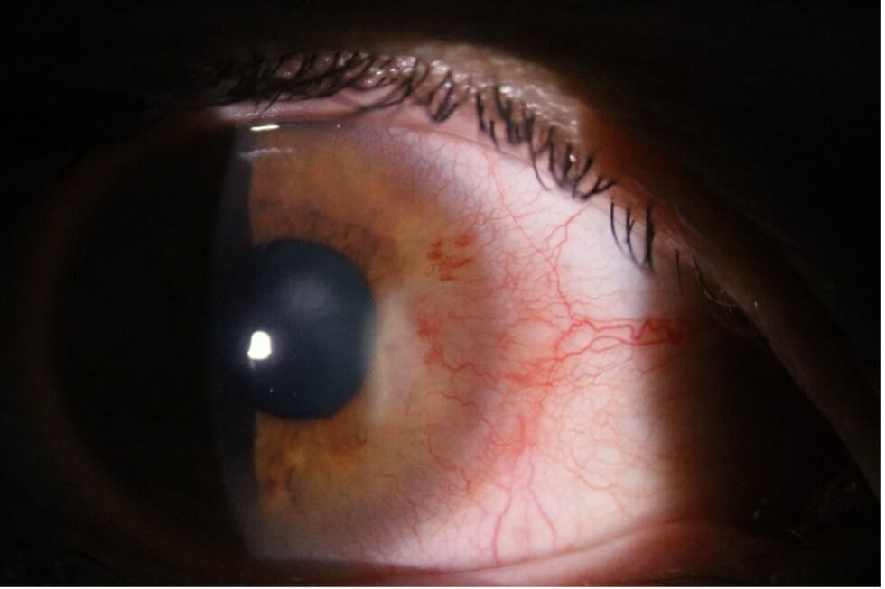 Causes & Management Lipid Keratopathy in Scleral Lens Wearers - mivision