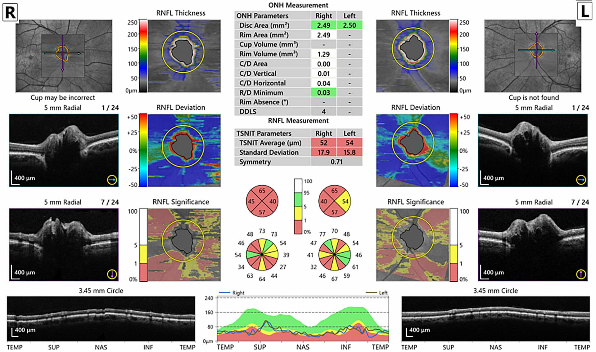 Navigating Visual Fields in Optic Nerve Head Drusen - mivision
