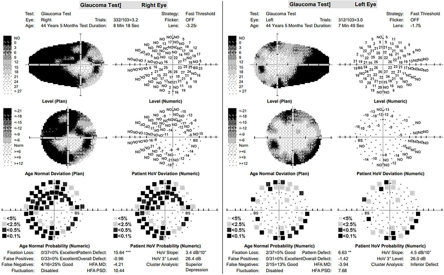 Navigating Visual Fields in Optic Nerve Head Drusen - mivision