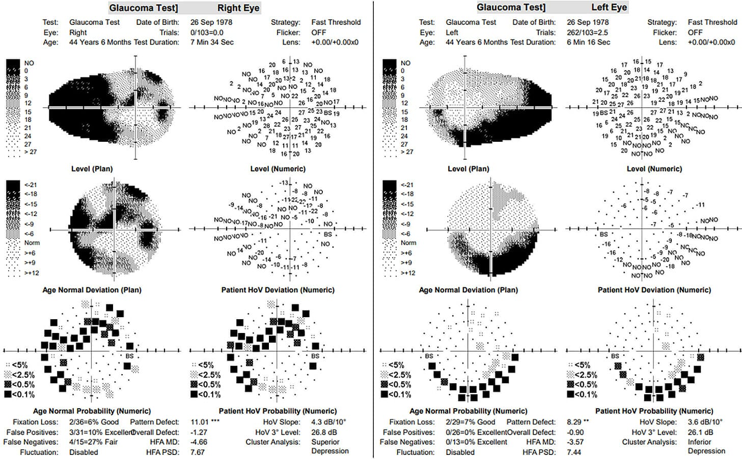 Navigating Visual Fields In Optic Nerve Head Drusen Mivision