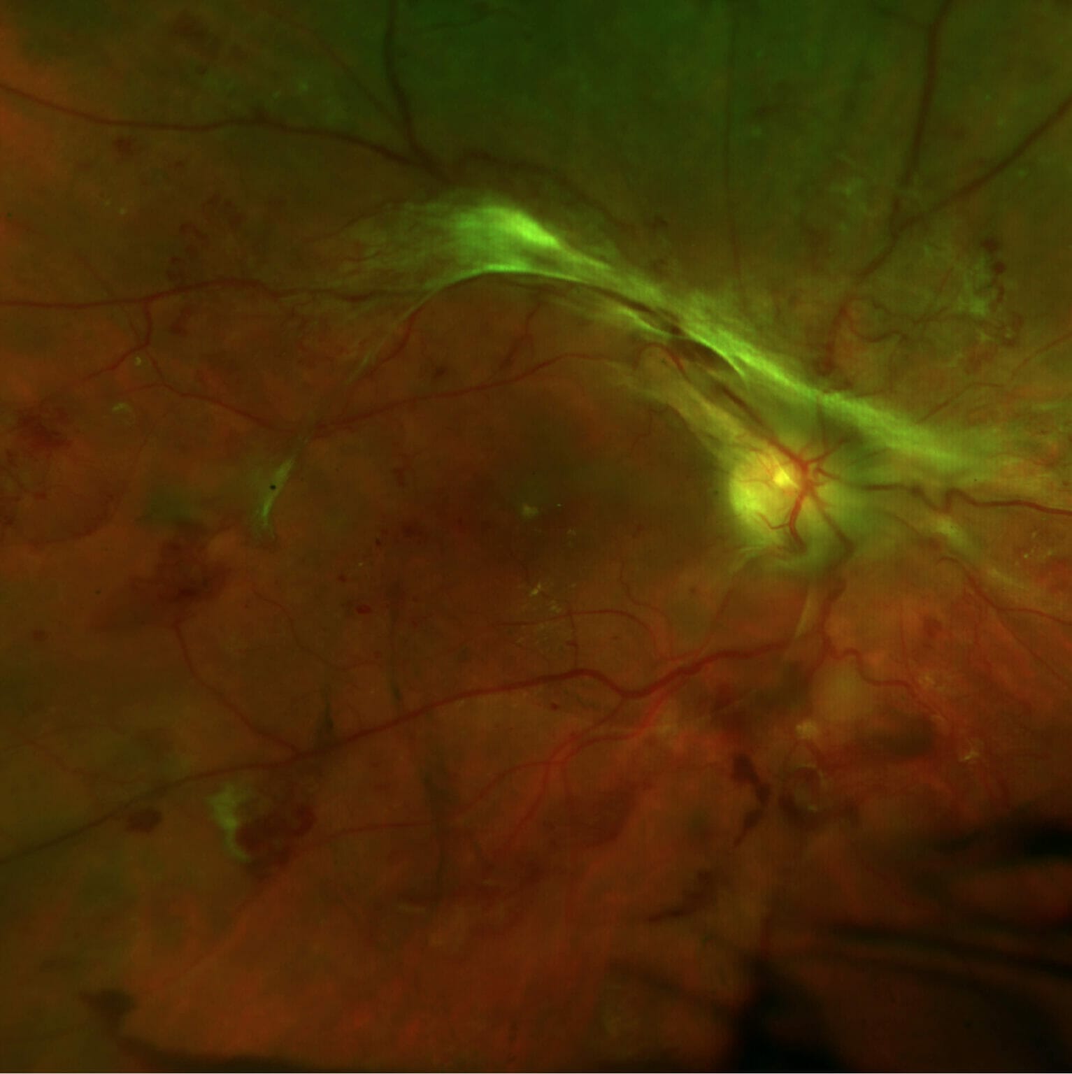 Severe Diabetic Retinopathy Management Update - mivision