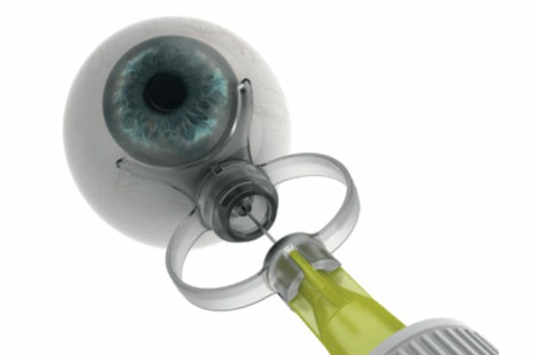 SP.Eye Intravitreal Device - mivision