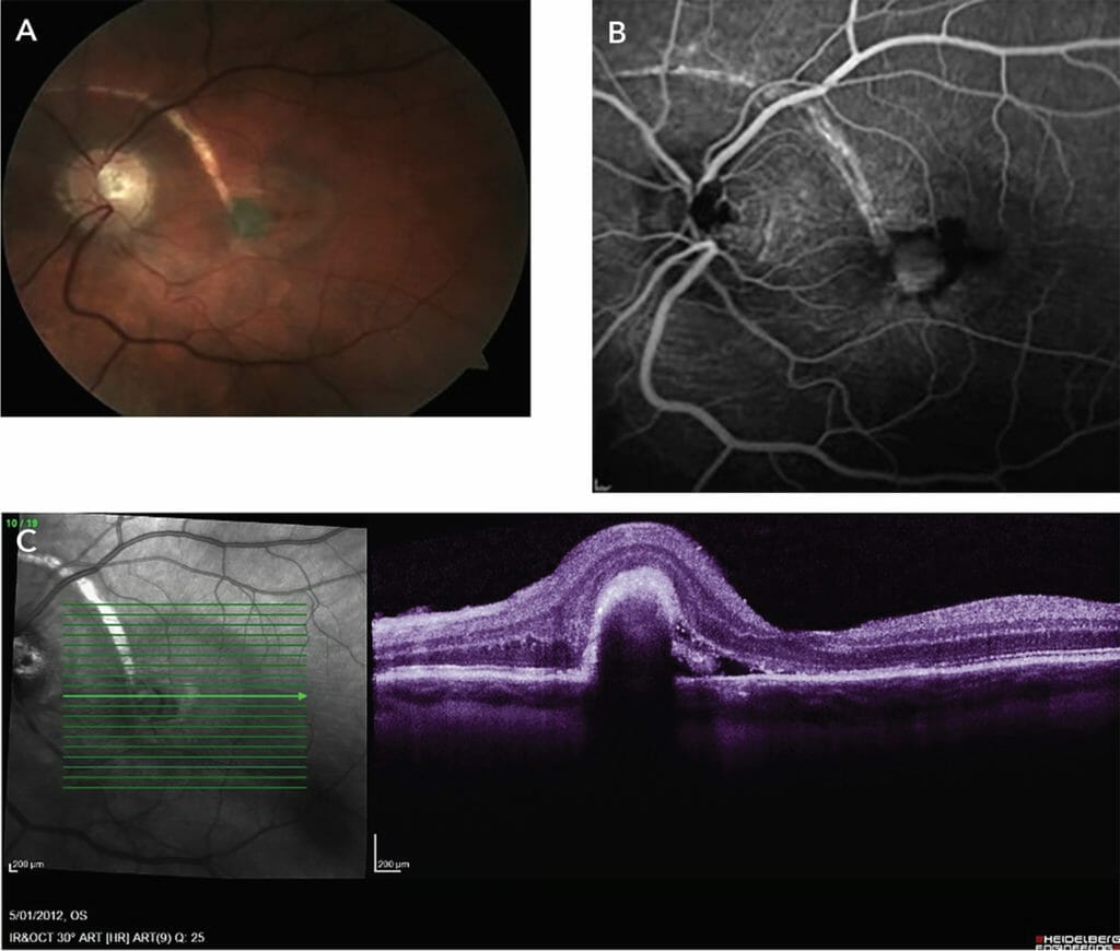 Posterior Eye Trauma Diagnosis Prevents Blindness - mivision