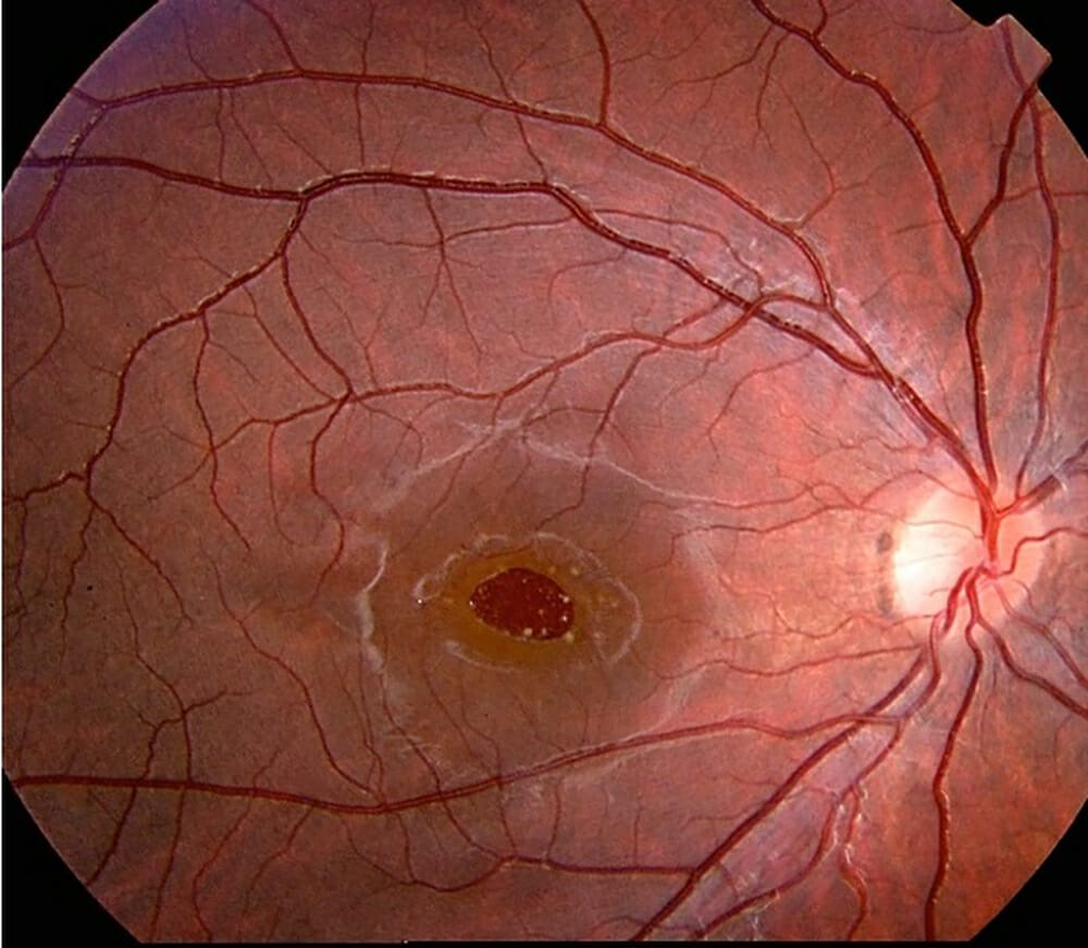 Posterior Eye Trauma Diagnosis Prevents Blindness - mivision