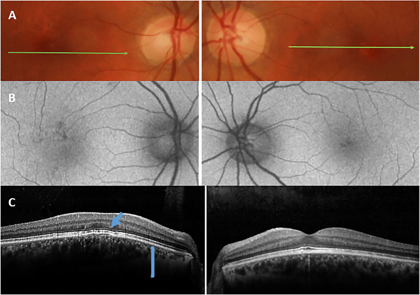 All the Colours of the Pachychoroid Spectrum - mivision