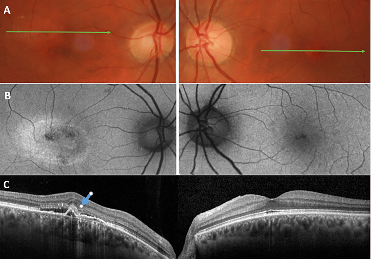 All the Colours of the Pachychoroid Spectrum - mivision