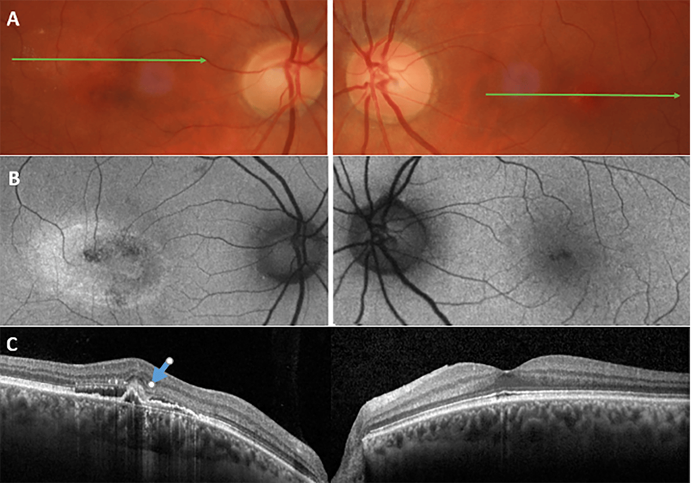 All the Colours of the Pachychoroid Spectrum - mivision