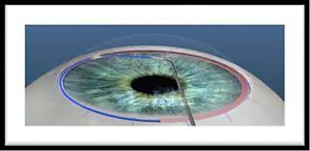 Devices Expanding Horizons: Minimally Invasive Glaucoma Surgery - mivision