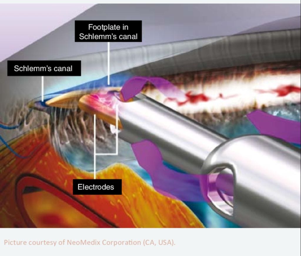 Devices Expanding Horizons: Minimally Invasive Glaucoma Surgery - mivision