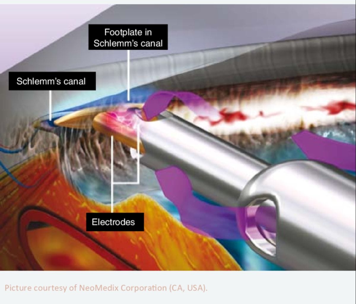 Devices Expanding Horizons: Minimally Invasive Glaucoma Surgery - mivision