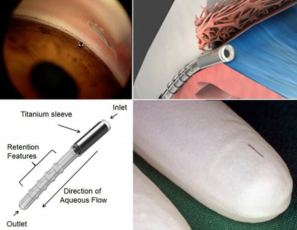 Devices Expanding Horizons: Minimally Invasive Glaucoma Surgery - mivision