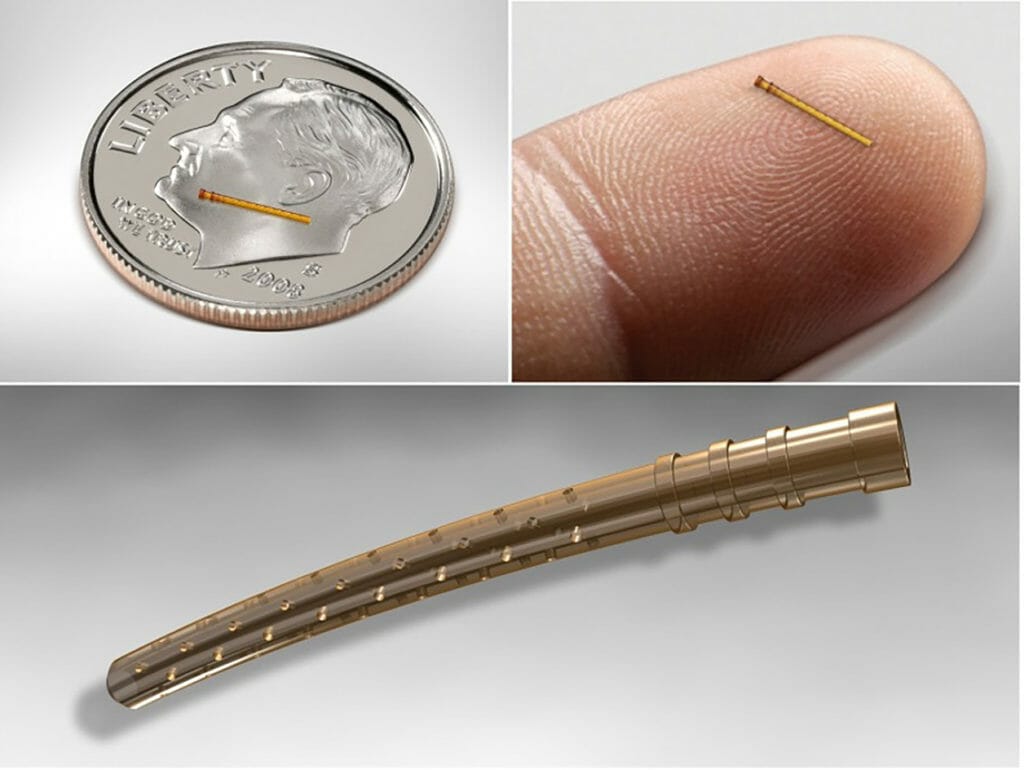 Devices Expanding Horizons: Minimally Invasive Glaucoma Surgery - mivision