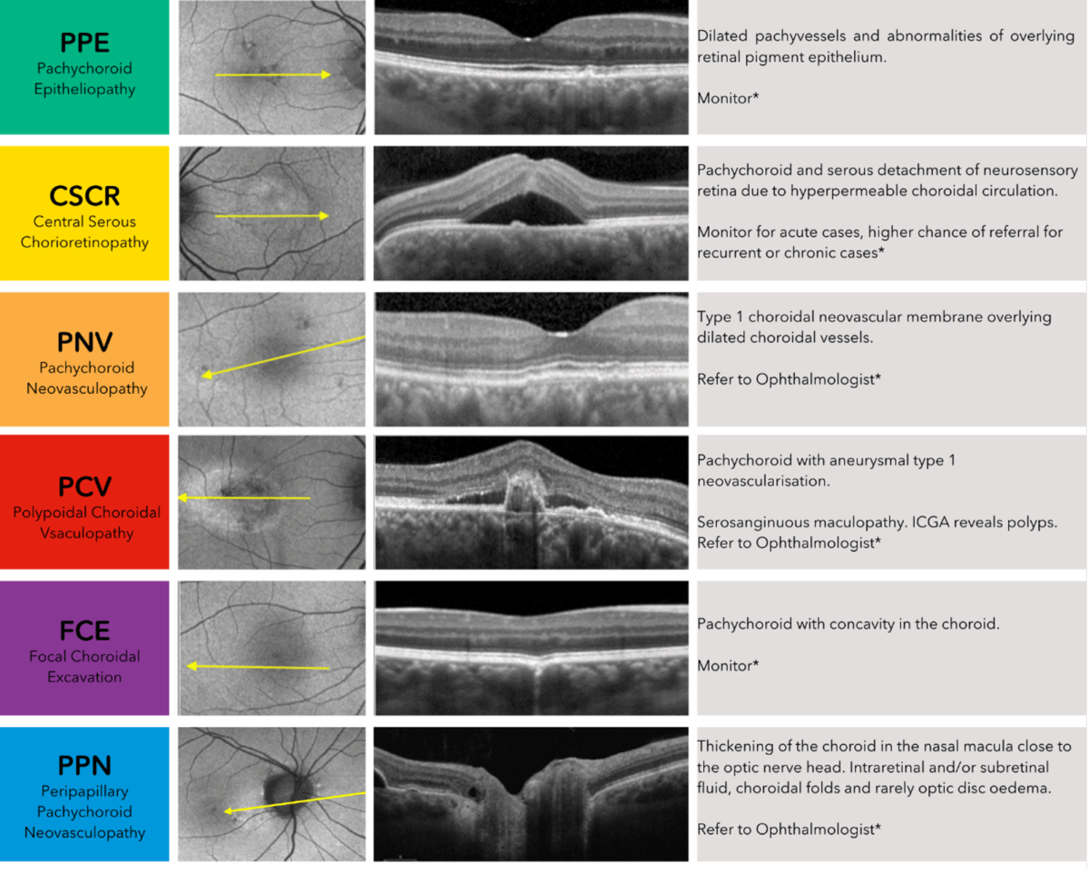 All the Colours of the Pachychoroid Spectrum - mivision