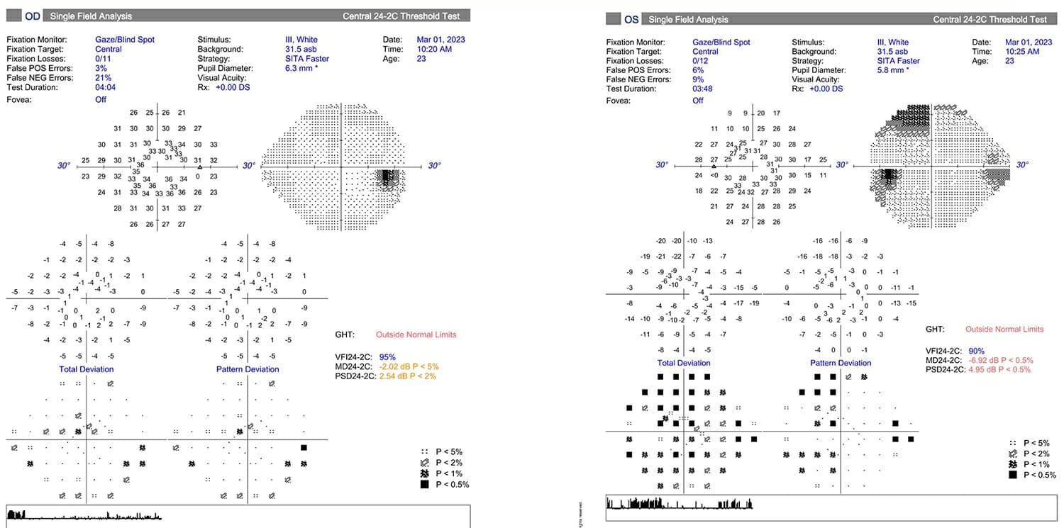 Optic Neuritis to Multiple Sclerosis - mivision