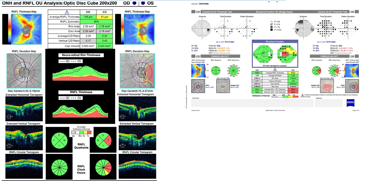 Optic Neuritis to Multiple Sclerosis - mivision
