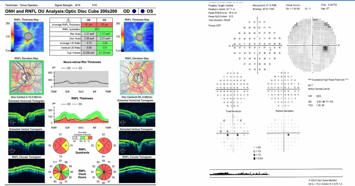 Optic Neuritis to Multiple Sclerosis - mivision