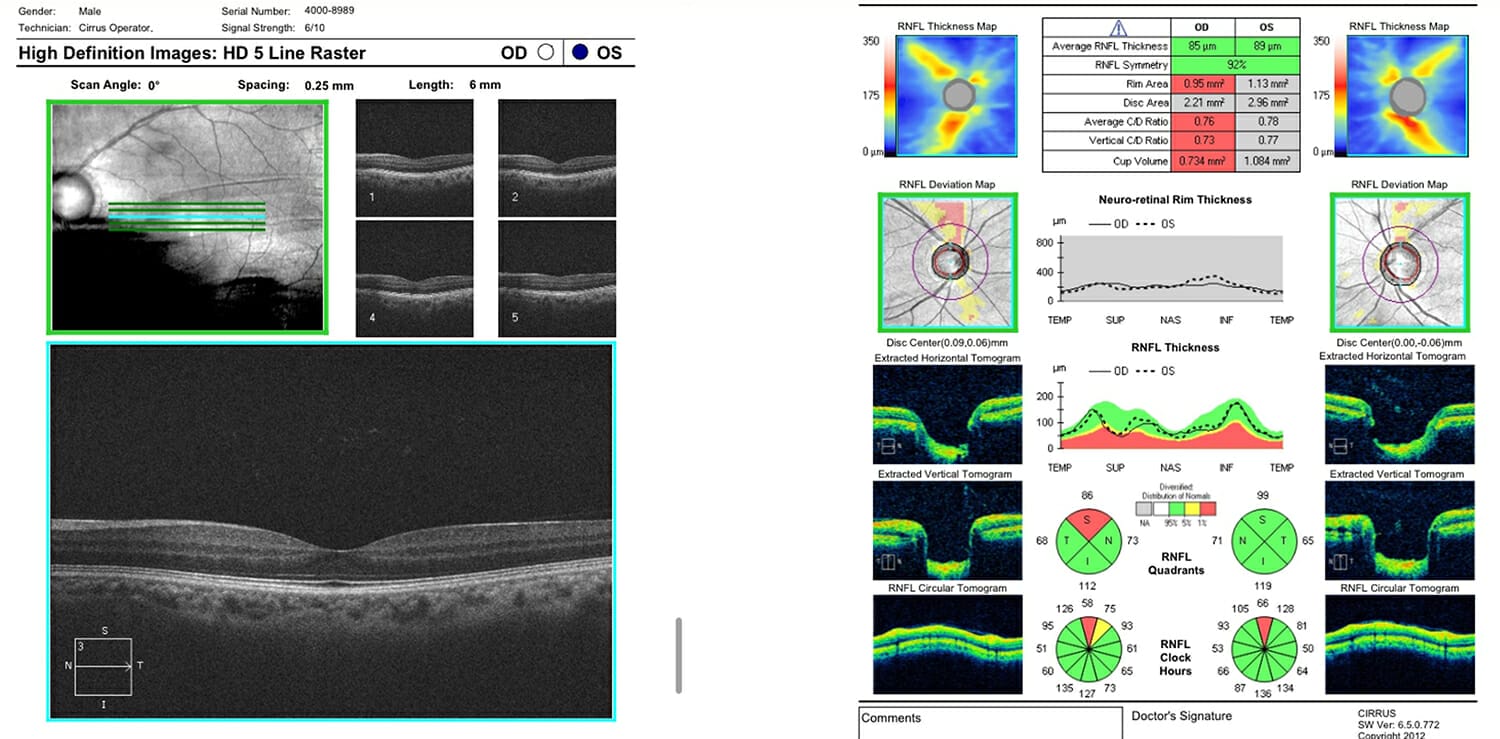 Optic Neuritis to Multiple Sclerosis - mivision