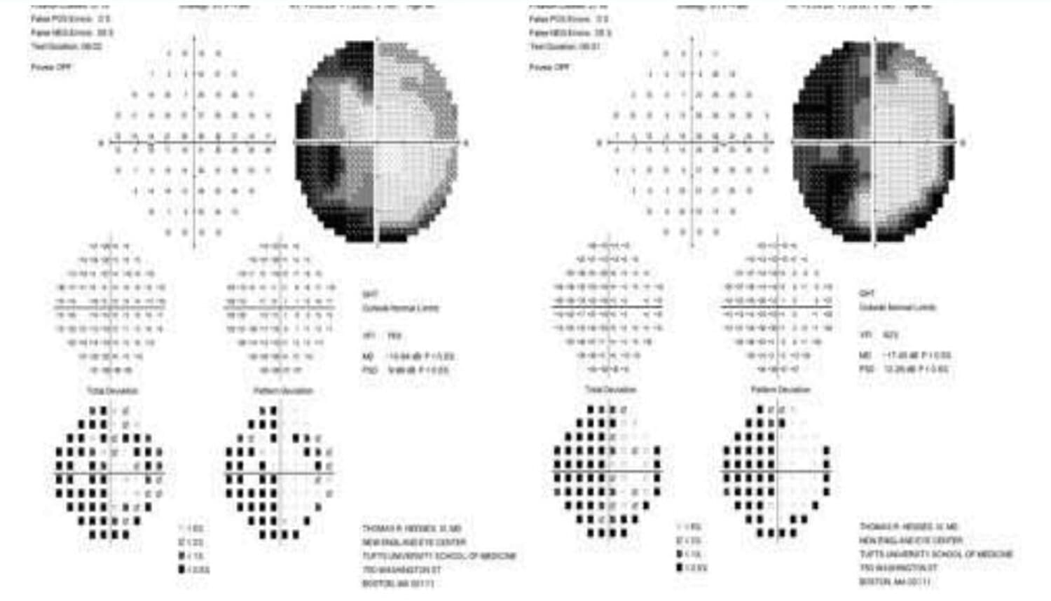 Optic Neuritis to Multiple Sclerosis - mivision