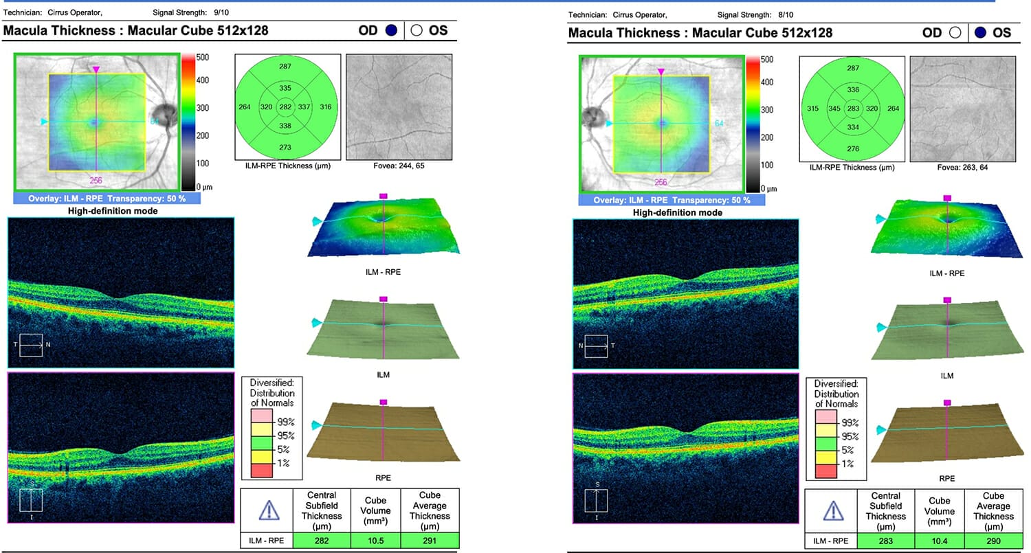 Optic Neuritis to Multiple Sclerosis - mivision