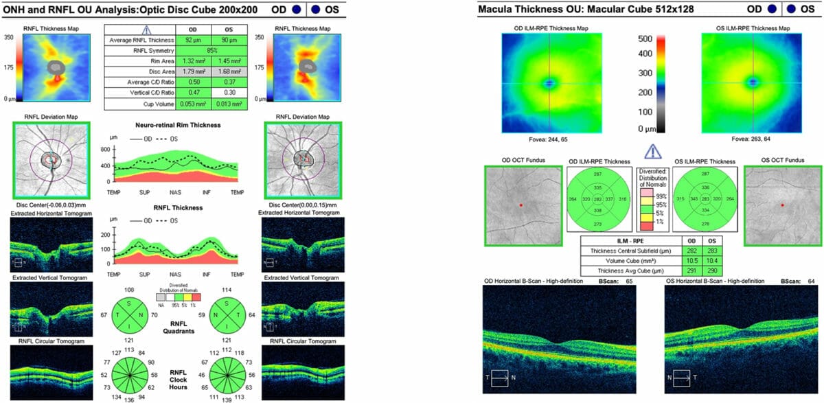 Optic Neuritis to Multiple Sclerosis - mivision