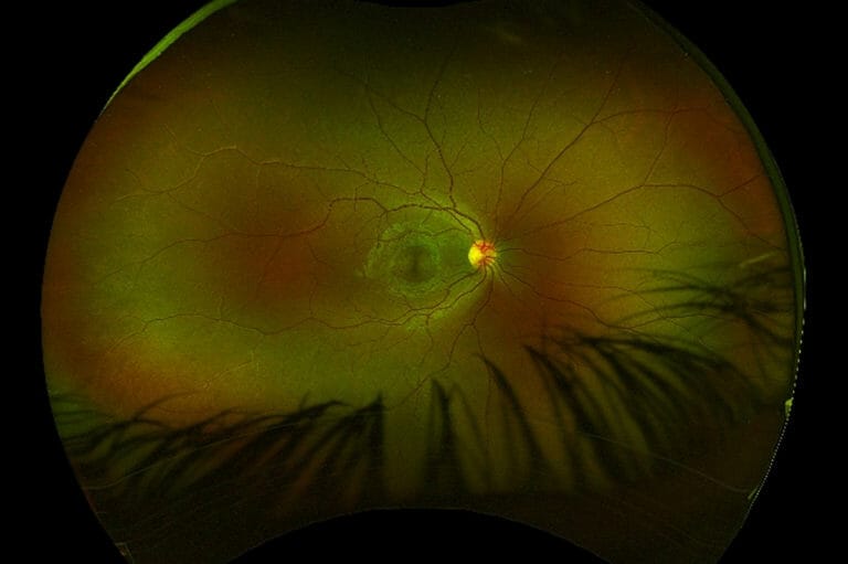 Optic Neuritis to Multiple Sclerosis - mivision