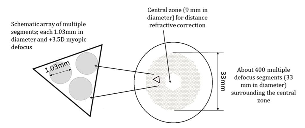 Evolving Technologies Spectacle Lenses for Myopia Control - mivision