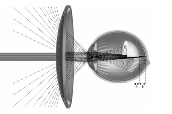 Evolving Technologies Spectacle Lenses for Myopia Control - mivision