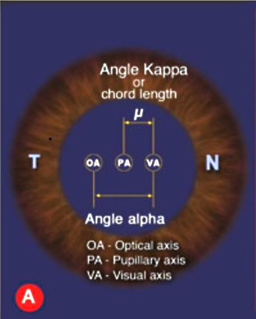 Presbyopia-Correcting IOLs: Shaping the Future of Clear Vision - mivision