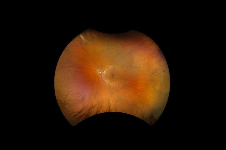 Key Milestones for Optos - mivision