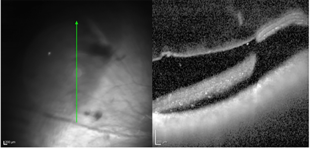 Epiretinal Membranes Looking Beyond the Macula - mivision