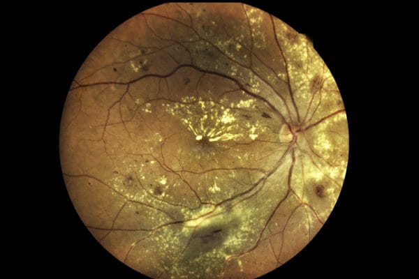 Faricimab Real World Treatment for AMD and DMO - mivision