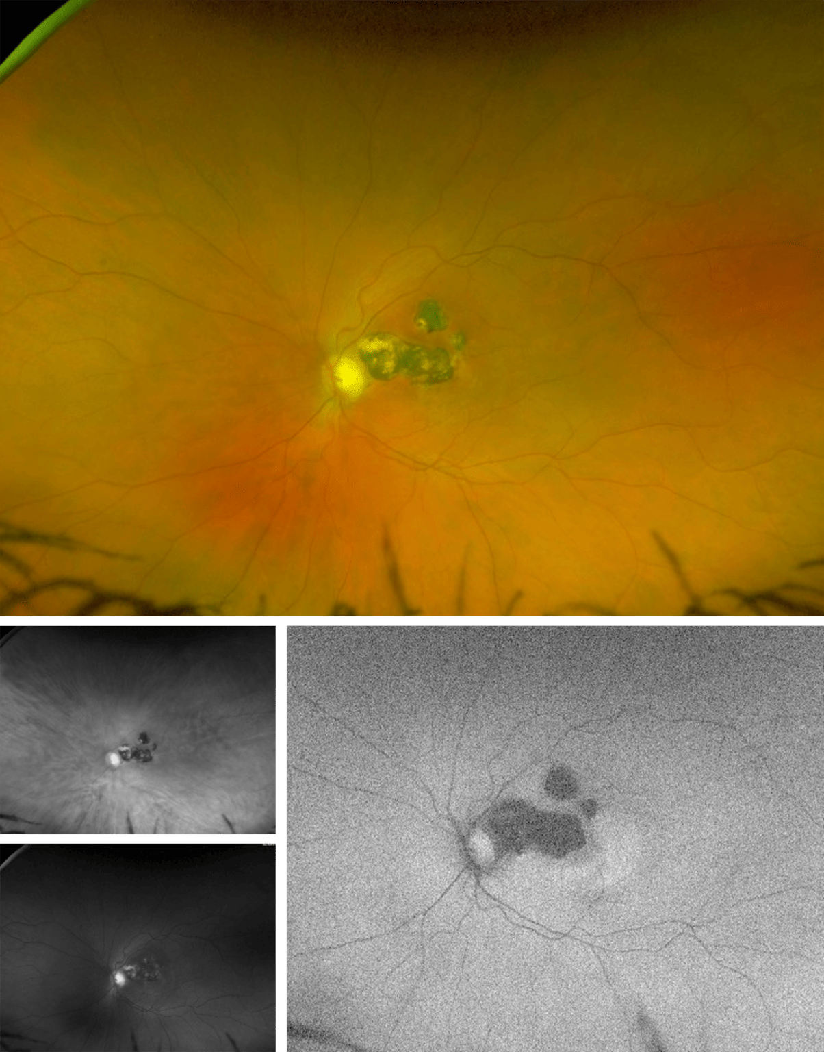 Epiretinal Membranes Looking Beyond the Macula - mivision